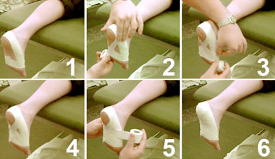 Plantar fasciitis taping – Rotherham Doncaster and South Humber NHS ...